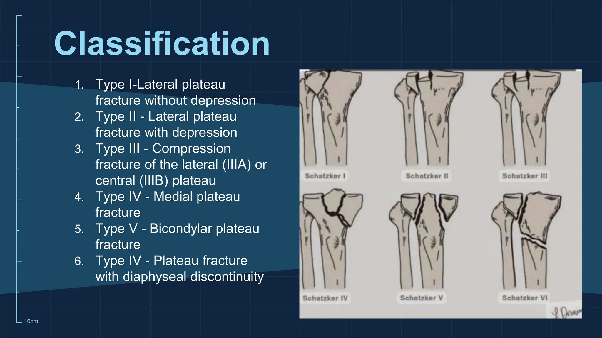proximal tibia fracture and mechanism with etiology | PPTX