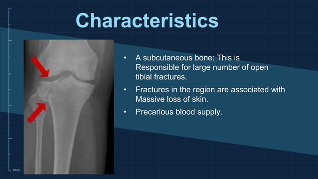 proximal tibia fracture and mechanism with etiology | PPTX