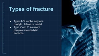 proximal tibia fracture and mechanism with etiology | PPTX