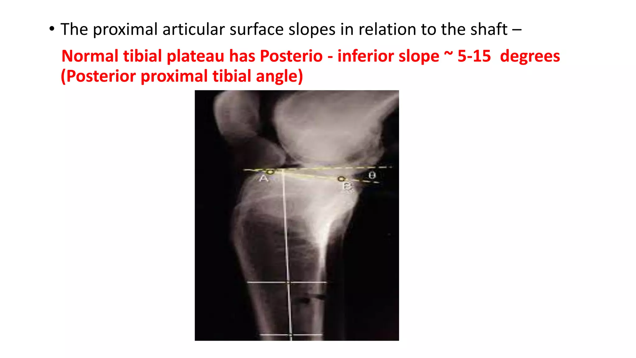 Proximal tibia fractures(Plateau, spine ,Tubercle and Epiphyseal ) | PPT