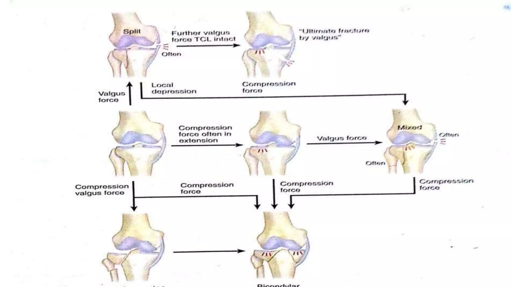 Proximal tibia fractures(Plateau, spine ,Tubercle and Epiphyseal ) | PPT