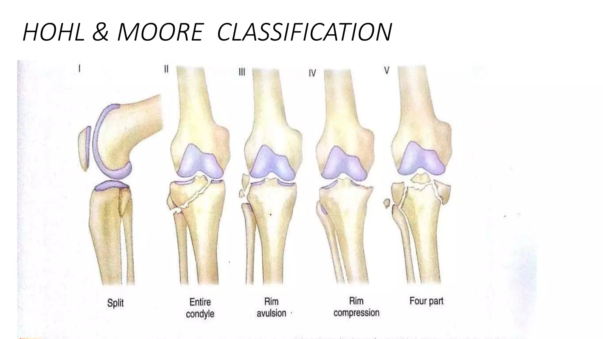 Proximal tibia fractures(Plateau, spine ,Tubercle and Epiphyseal ) | PPT