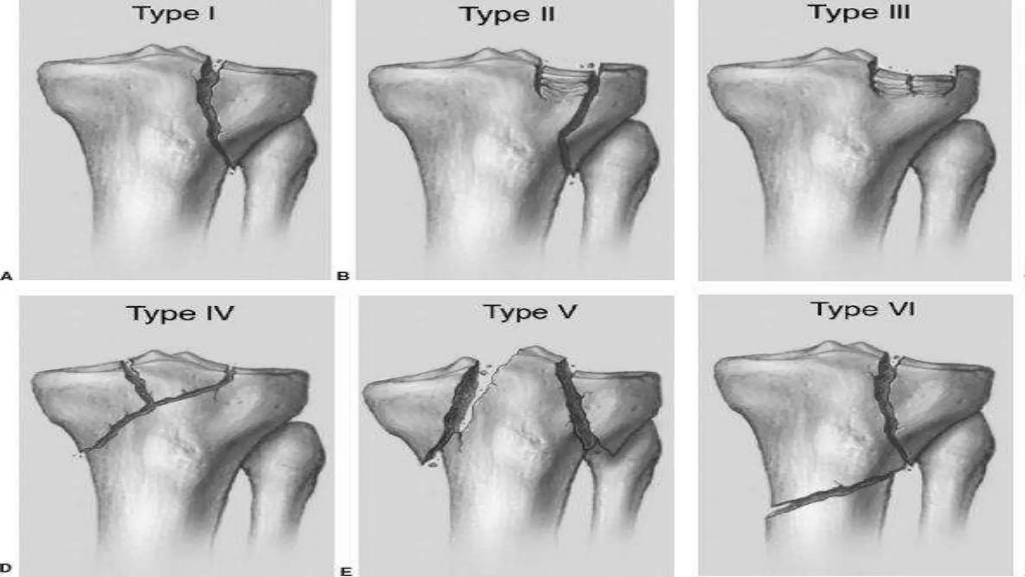 Proximal tibia fractures(Plateau, spine ,Tubercle and Epiphyseal ) | PPT