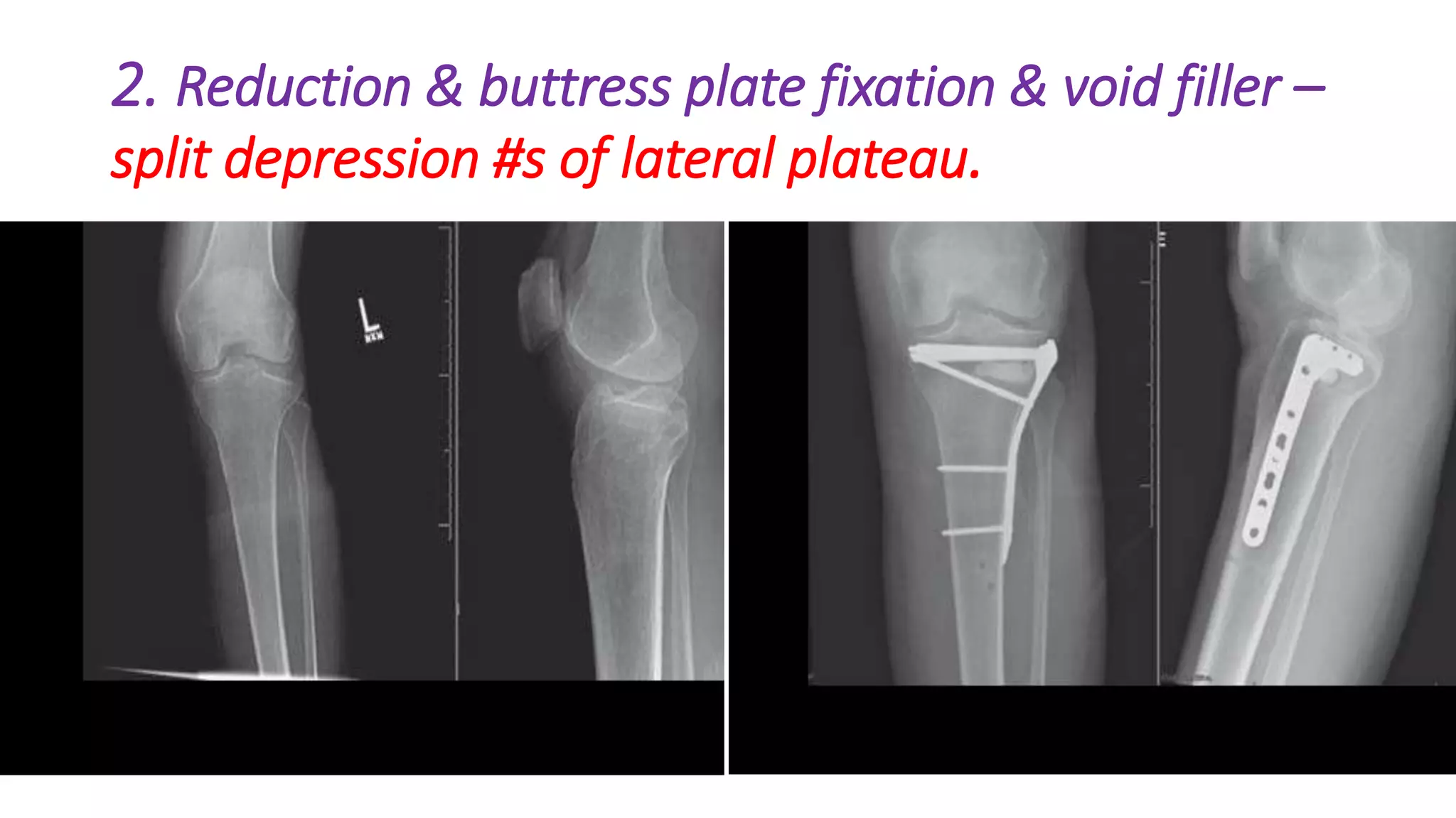 Proximal tibia fractures(Plateau, spine ,Tubercle and Epiphyseal ) | PPT