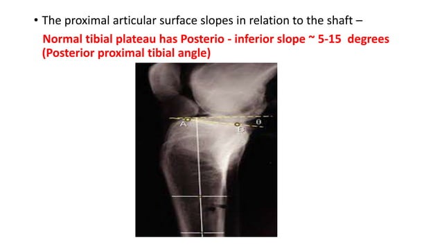 Proximal tibia fractures(Plateau, spine ,Tubercle and Epiphyseal ...