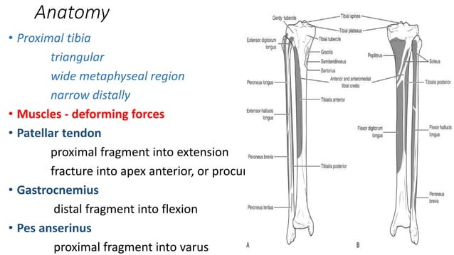 Proximal tibia fractures(Plateau, spine ,Tubercle and Epiphyseal ...
