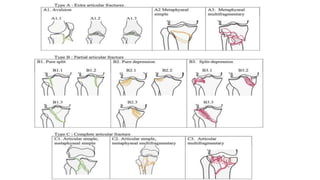 Proximal tibia fractures(Plateau, spine ,Tubercle and Epiphyseal ) | PPT