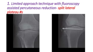 Proximal tibia fractures(Plateau, spine ,Tubercle and Epiphyseal ) | PPT