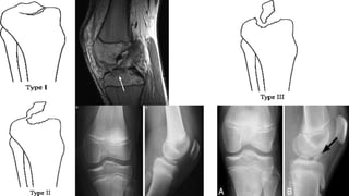 Proximal tibia fractures(Plateau, spine ,Tubercle and Epiphyseal ) | PPT
