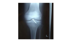 Proximal tibia fractures(Plateau, spine ,Tubercle and Epiphyseal ) | PPT
