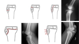 Proximal tibia fractures(Plateau, spine ,Tubercle and Epiphyseal ) | PPT