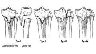 Proximal tibia fractures(Plateau, spine ,Tubercle and Epiphyseal ) | PPT
