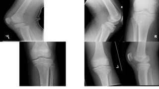 Proximal tibia fractures(Plateau, spine ,Tubercle and Epiphyseal ) | PPT