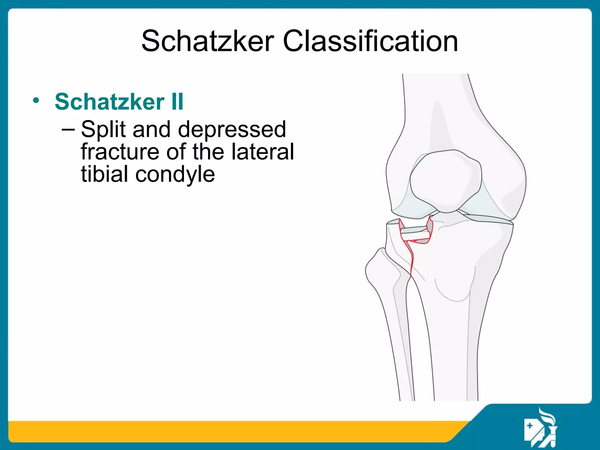 Proximal tibial fracture | PPT