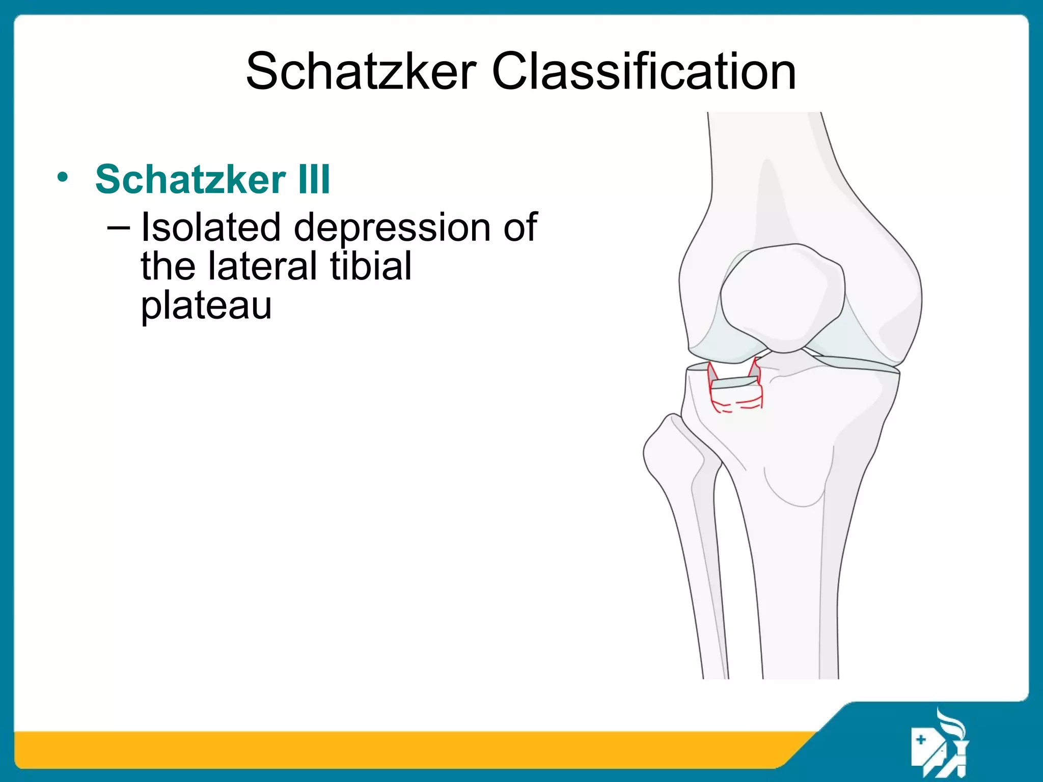 Proximal tibial fracture | PPT
