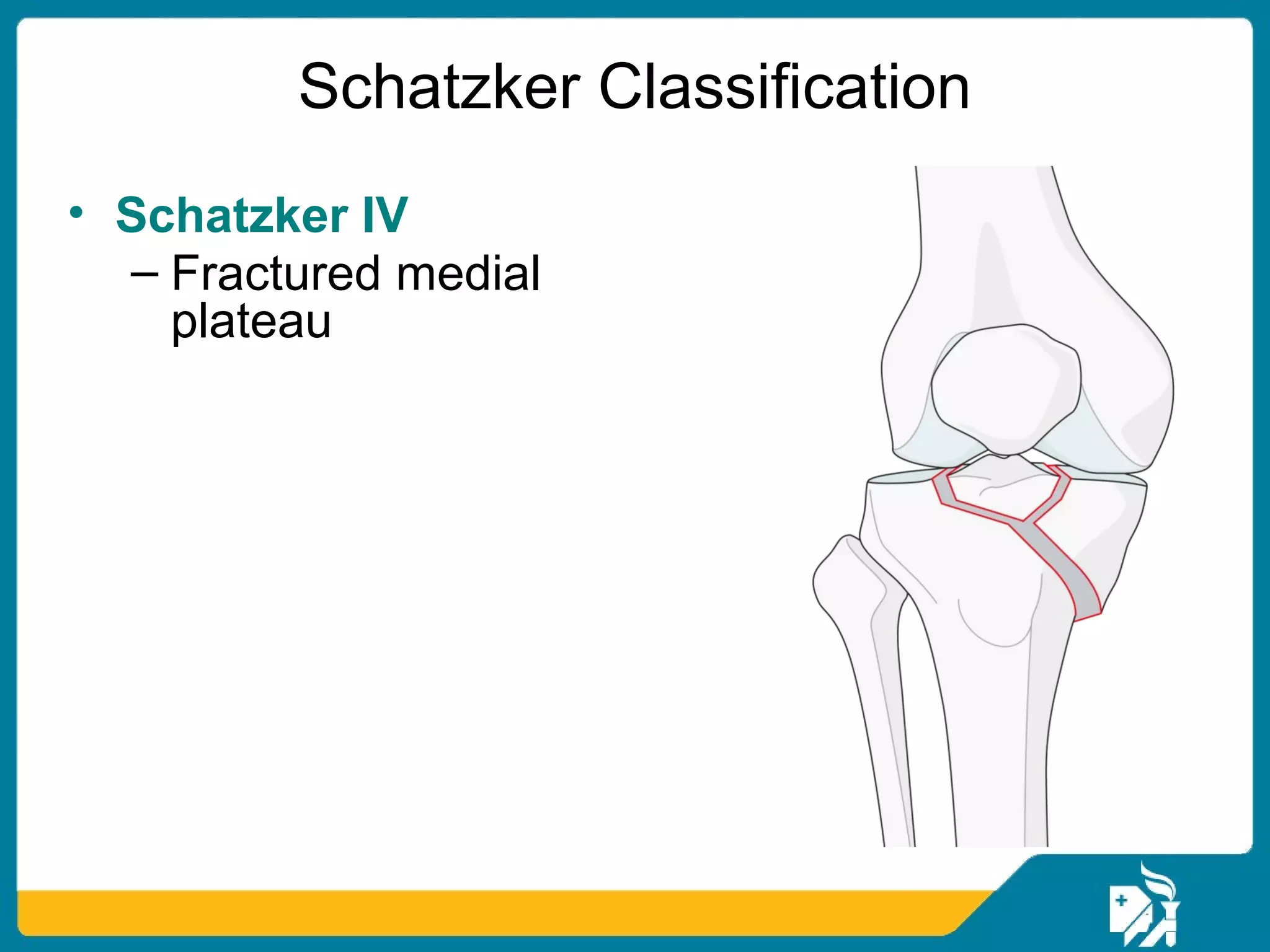 Proximal tibial fracture | PPT