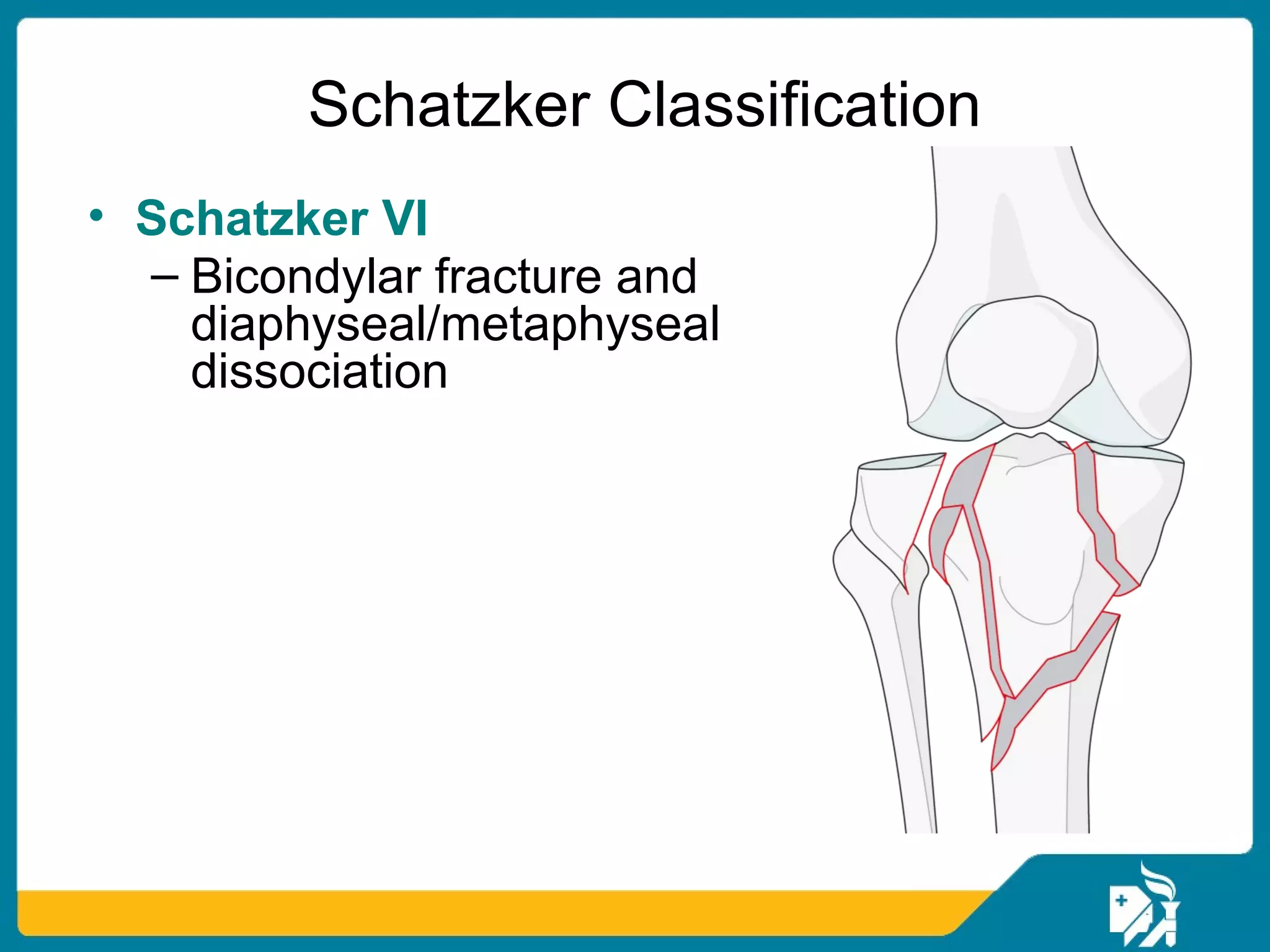 Proximal tibial fracture | PPT
