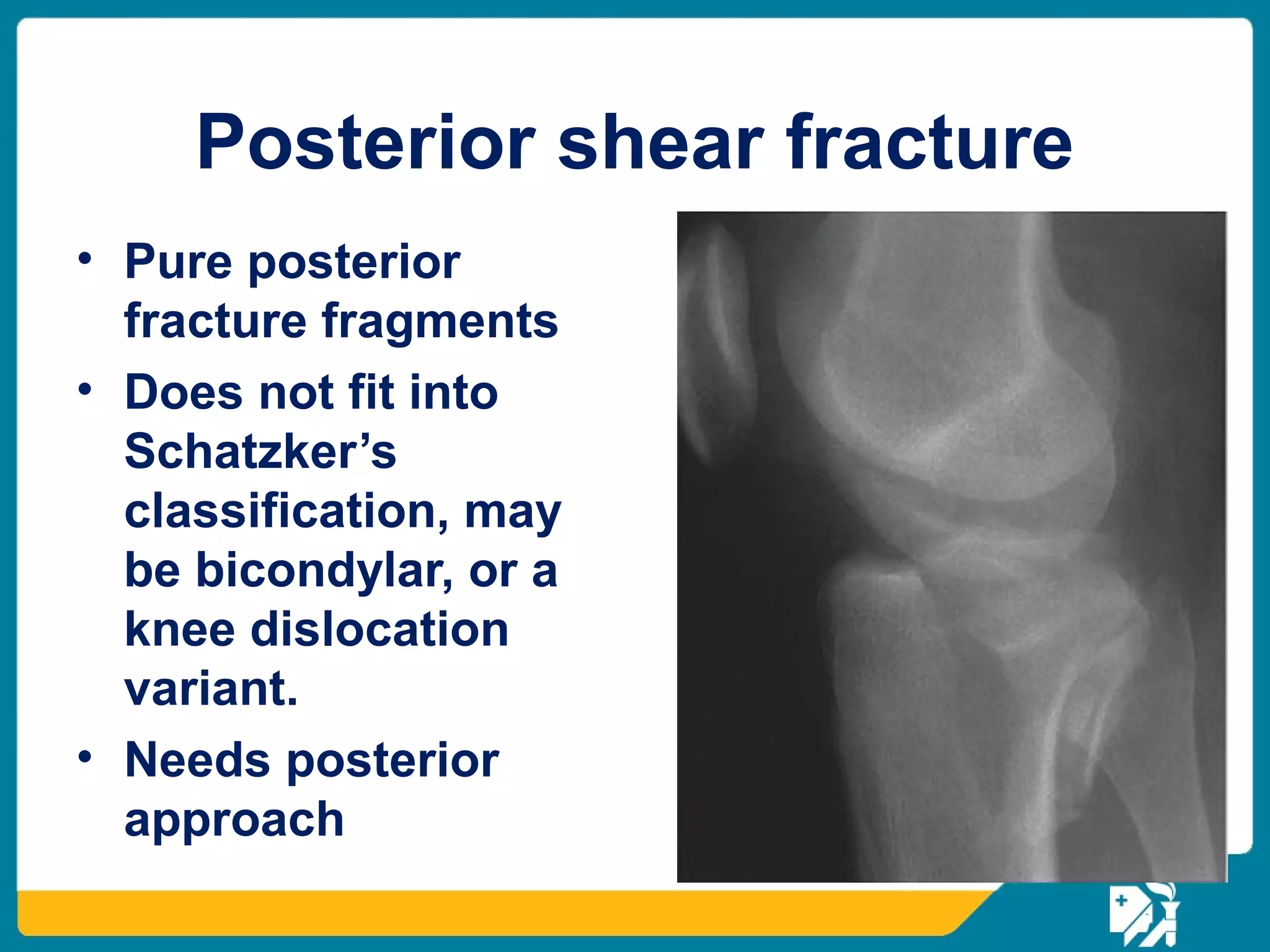 Proximal tibial fracture | PPT
