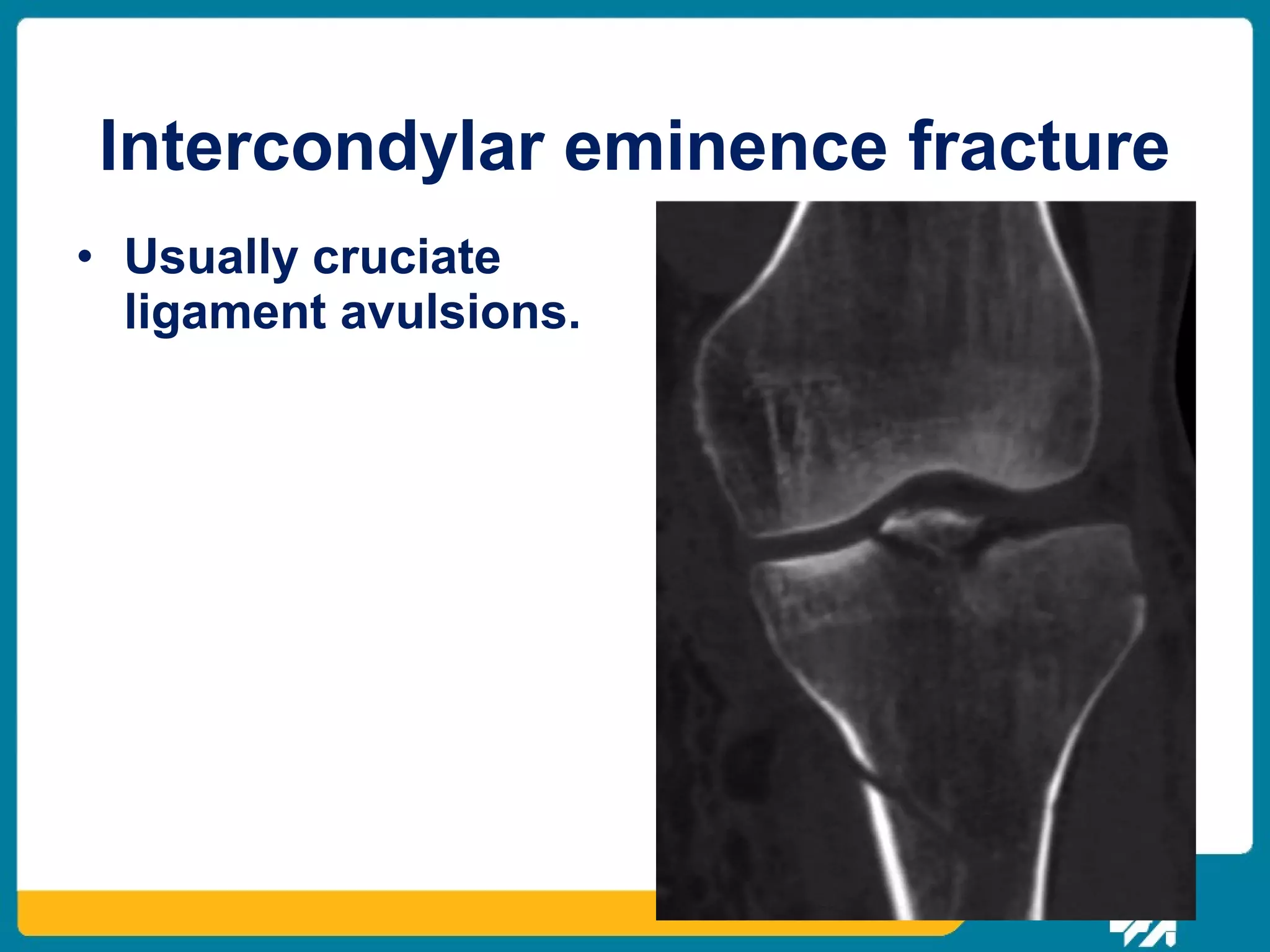 Proximal tibial fracture | PPT