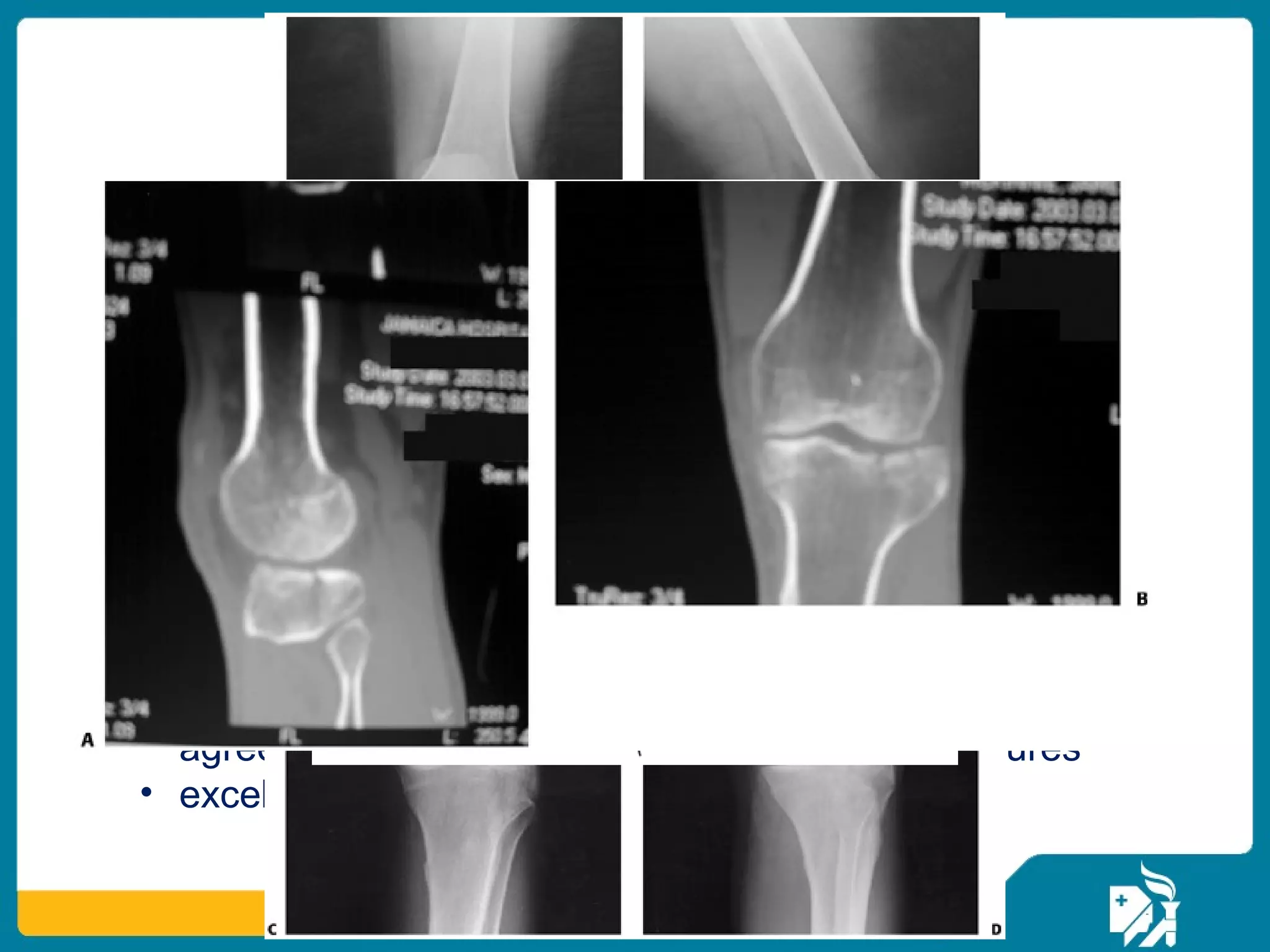 Proximal tibial fracture | PPT