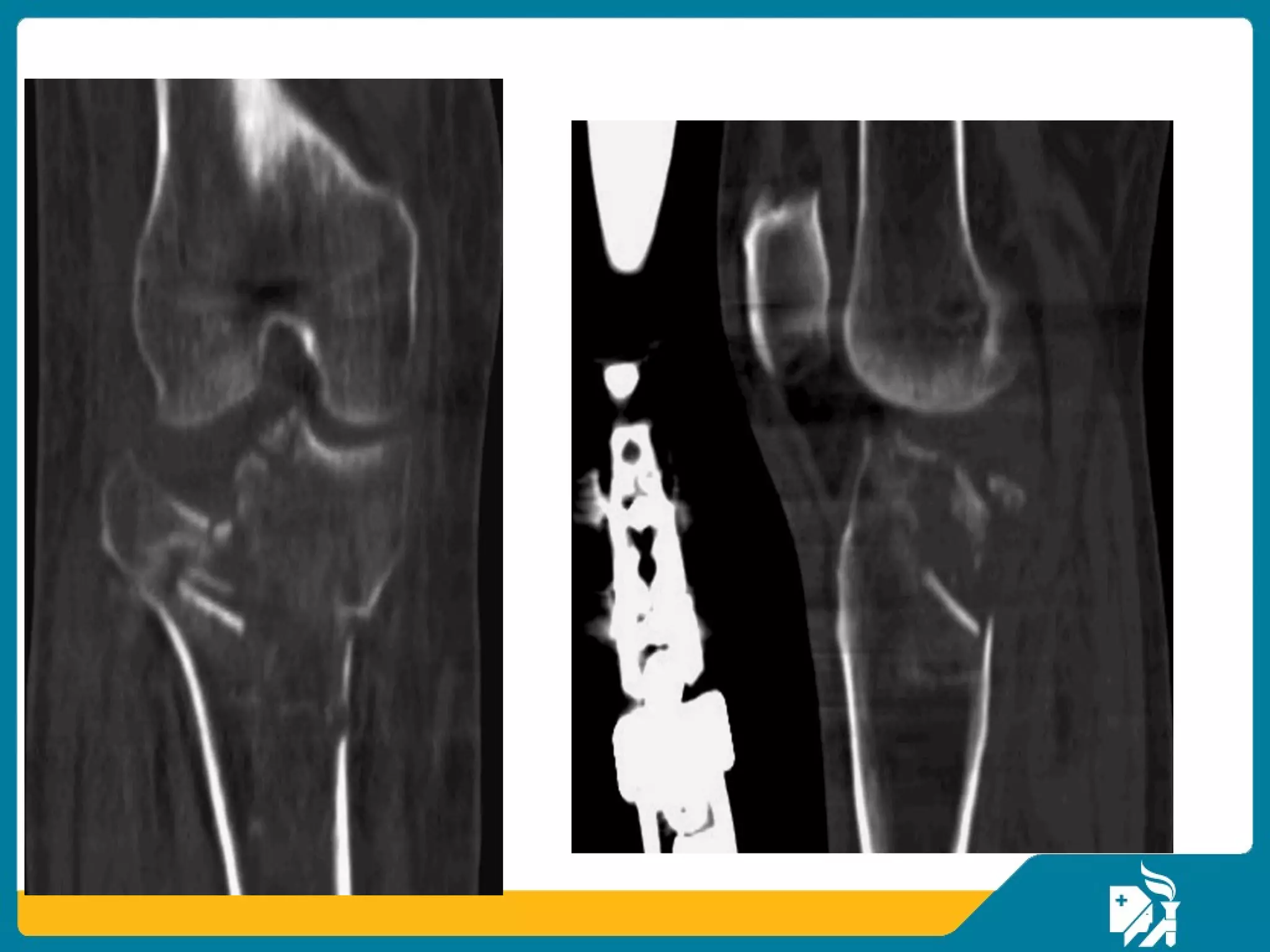 Proximal tibial fracture | PPT