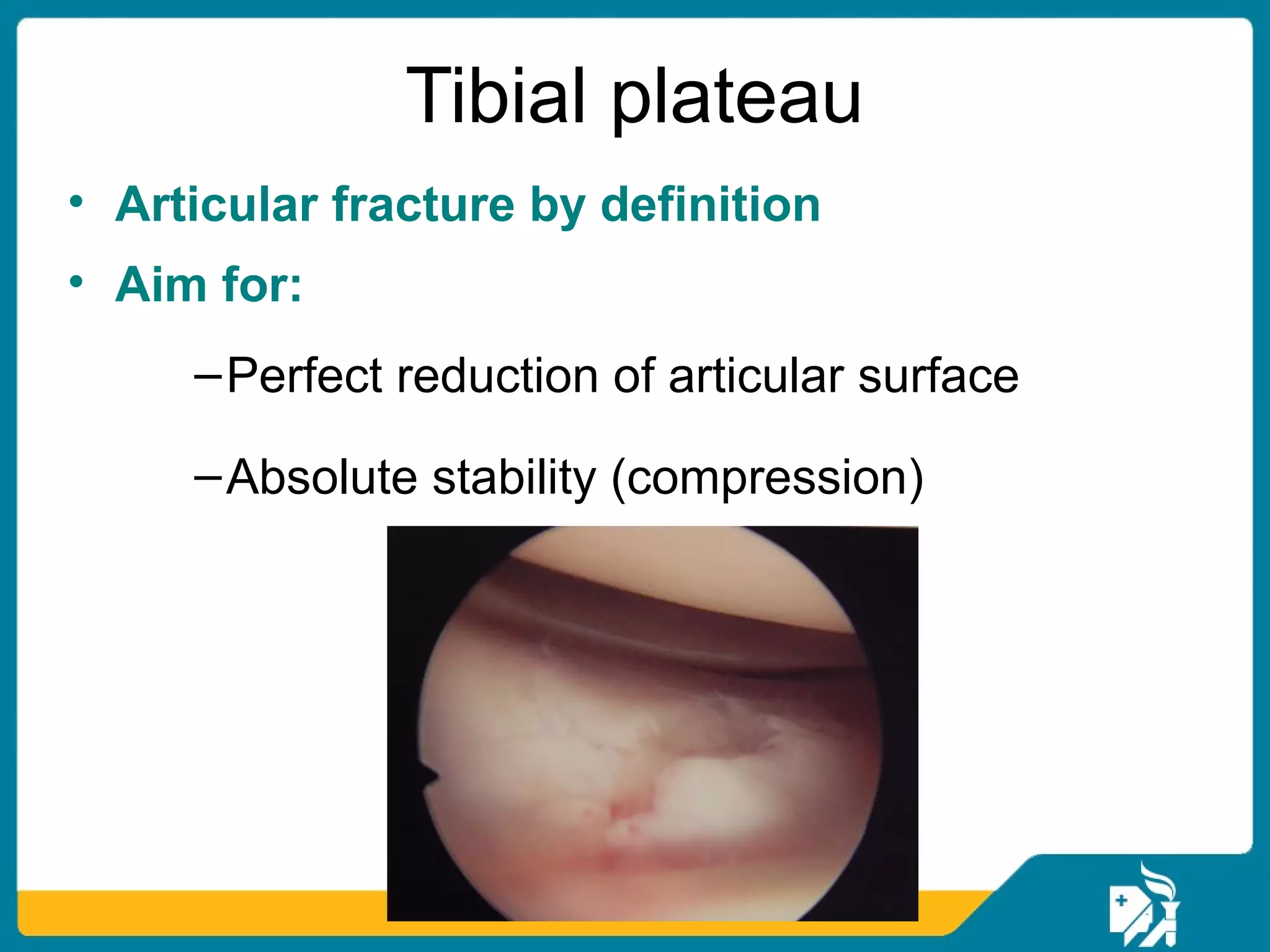 Proximal tibial fracture | PPT
