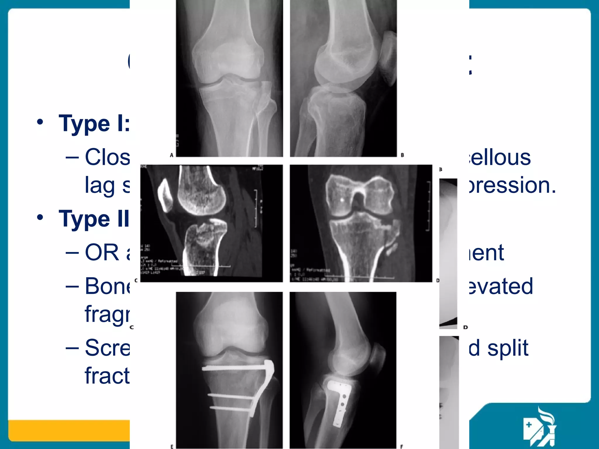 Proximal tibial fracture | PPT