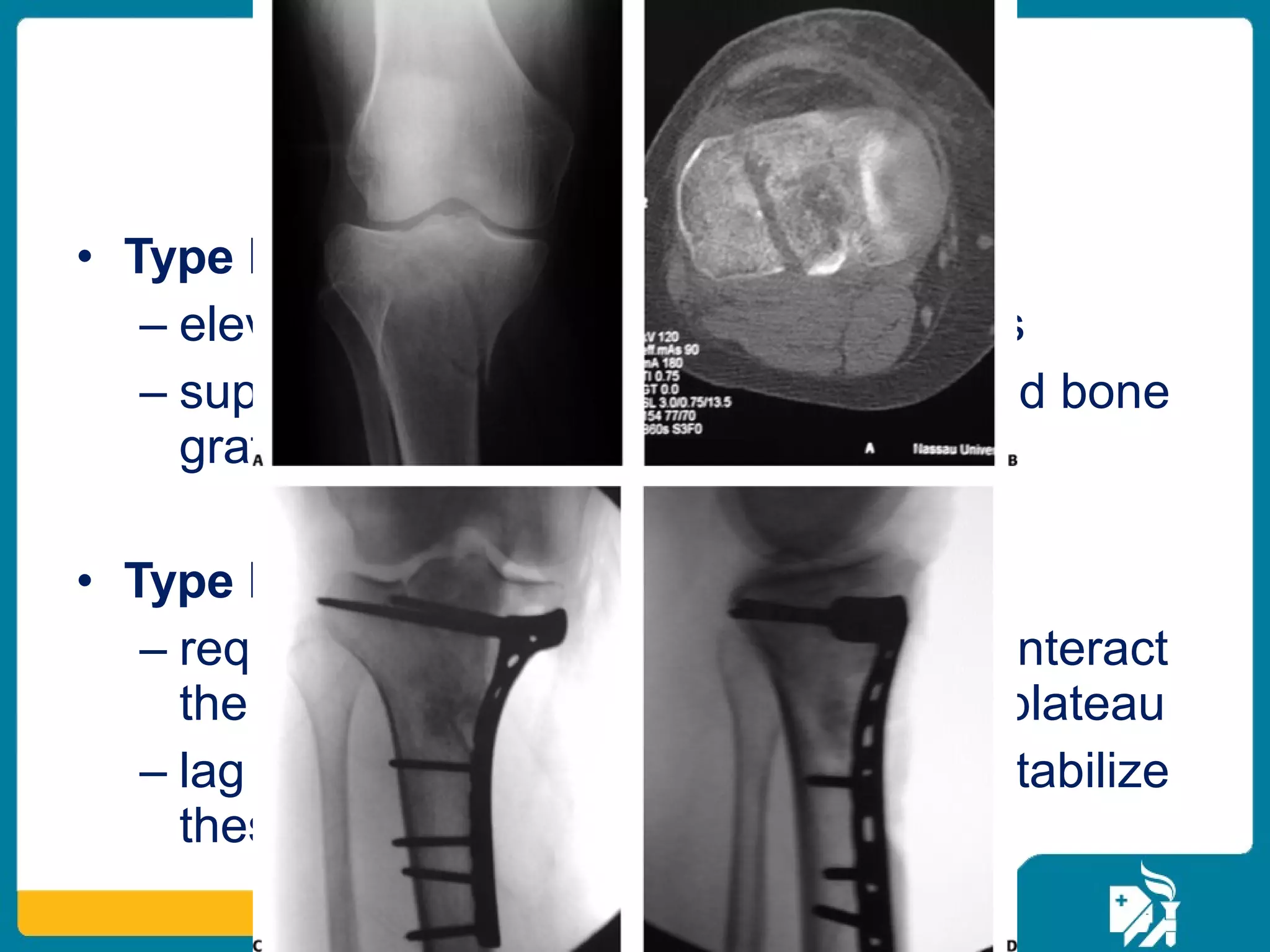 Proximal tibial fracture | PPT