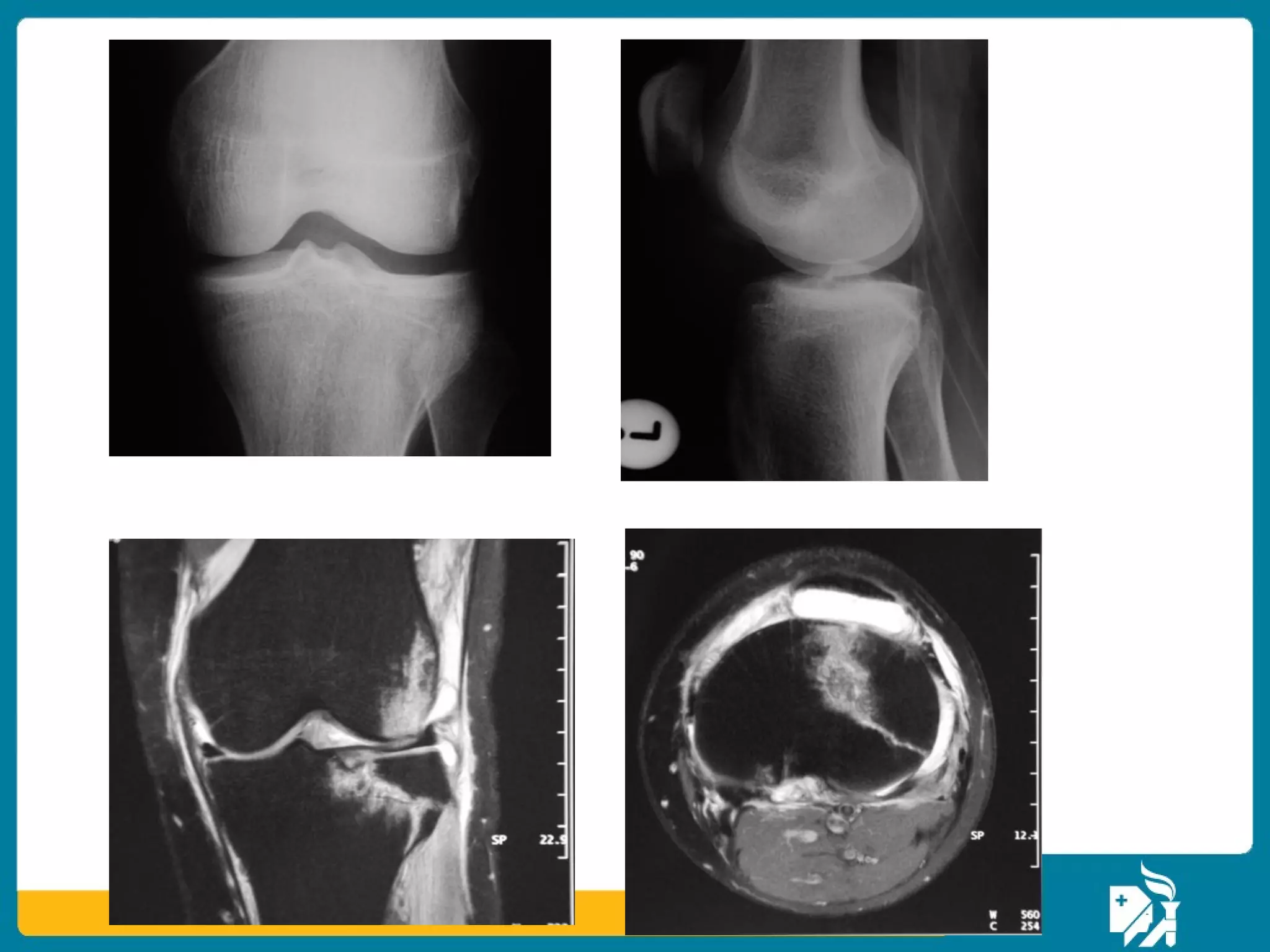 Proximal tibial fracture | PPT