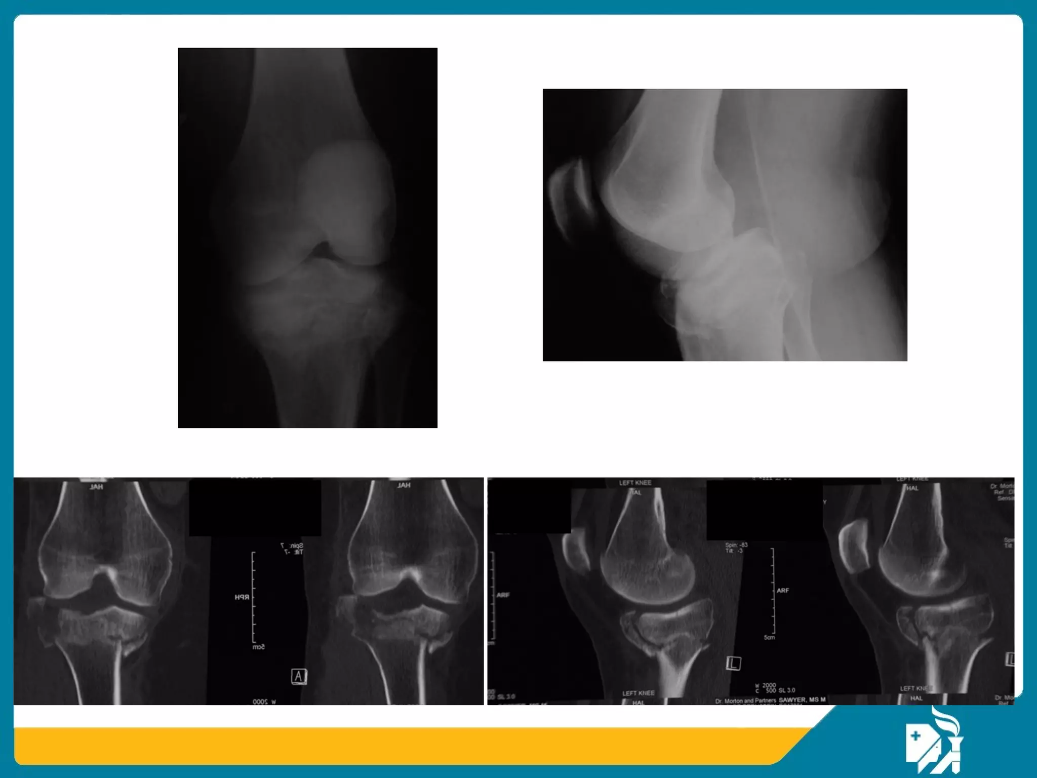Proximal tibial fracture | PPT