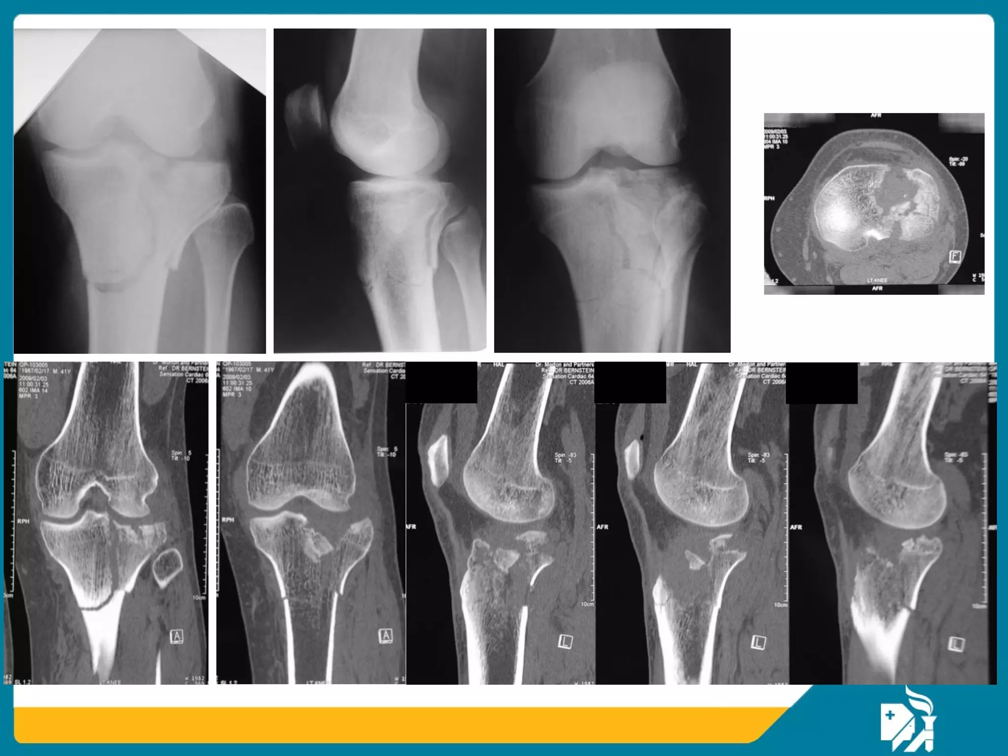 Proximal tibial fracture | PPT