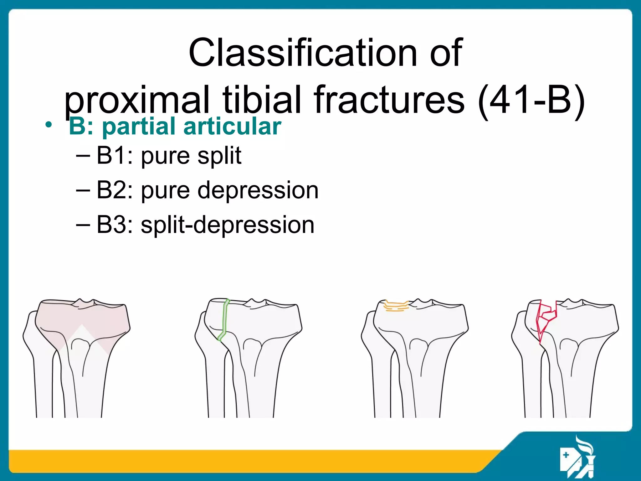 Proximal tibial fracture | PPT