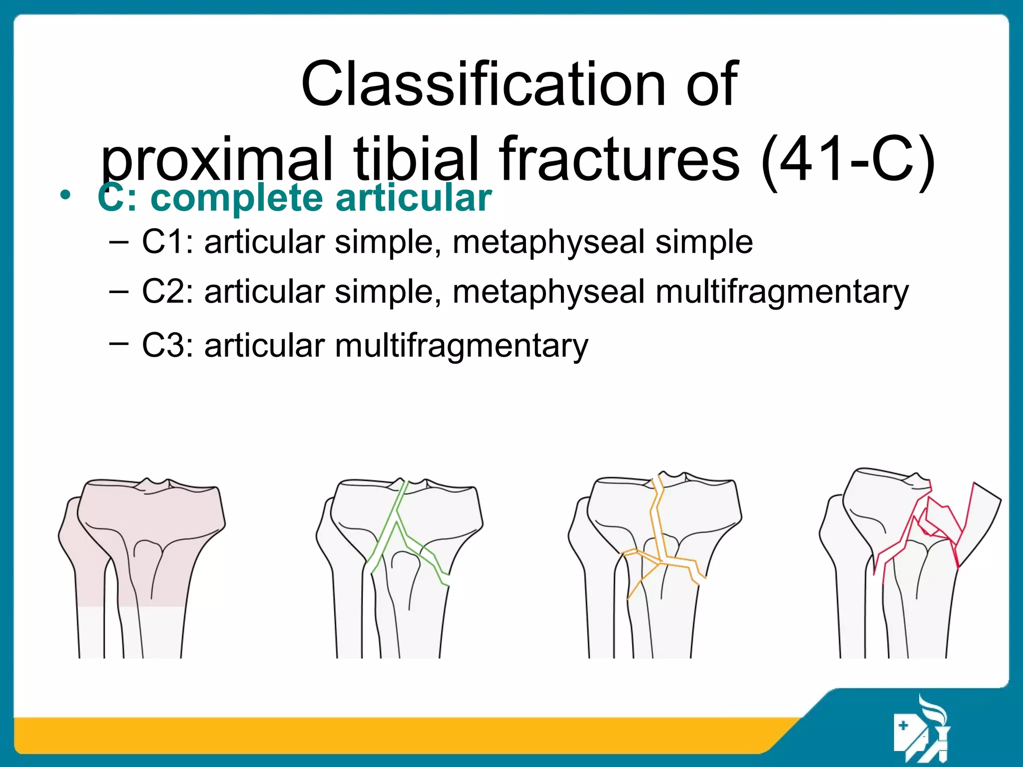 Proximal tibial fracture | PPT