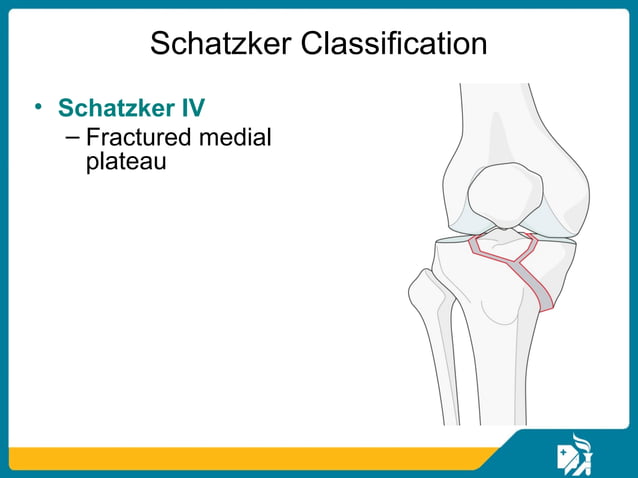 Proximal tibial fracture | PPT