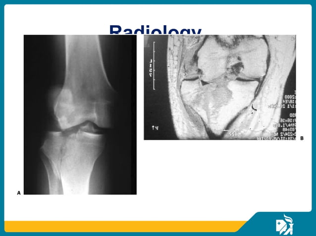 Proximal tibial fracture | PPT