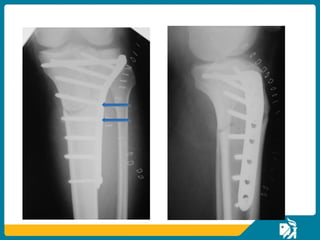 Proximal tibial fracture | PPT