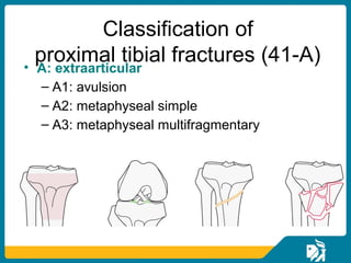 Proximal tibial fracture | PPT