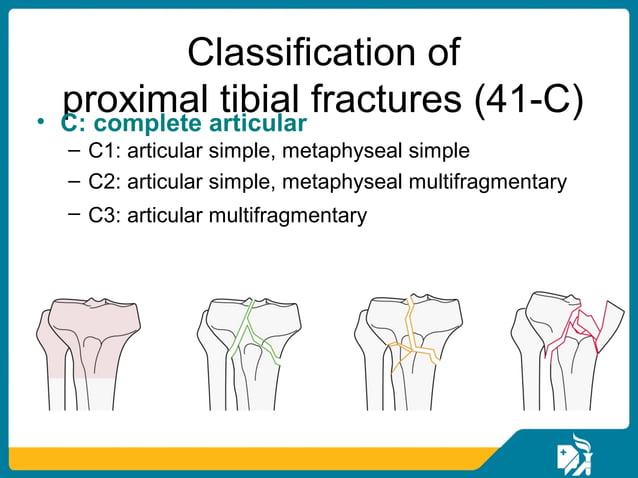 Proximal tibial fracture | PPT