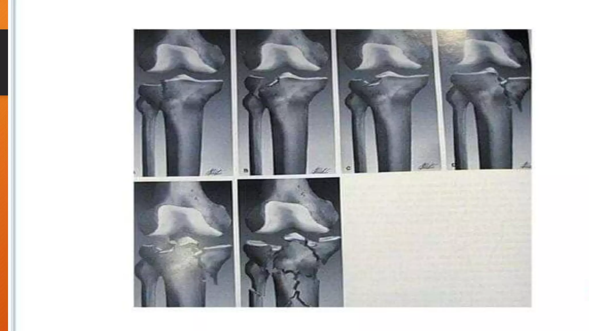 PROXIMAL TIBIAL FRACTURE.pptx