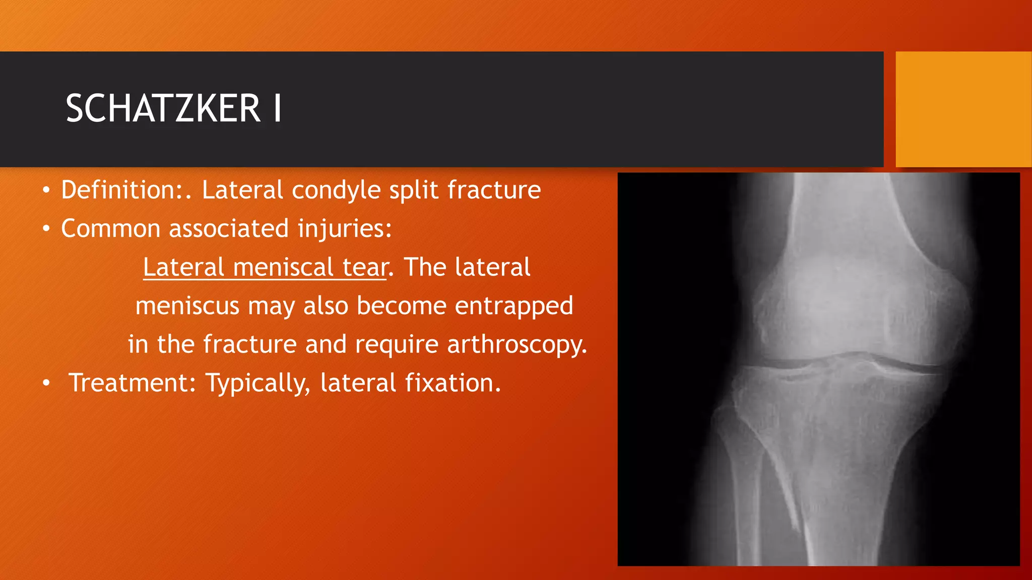 PROXIMAL TIBIAL FRACTURE.pptx