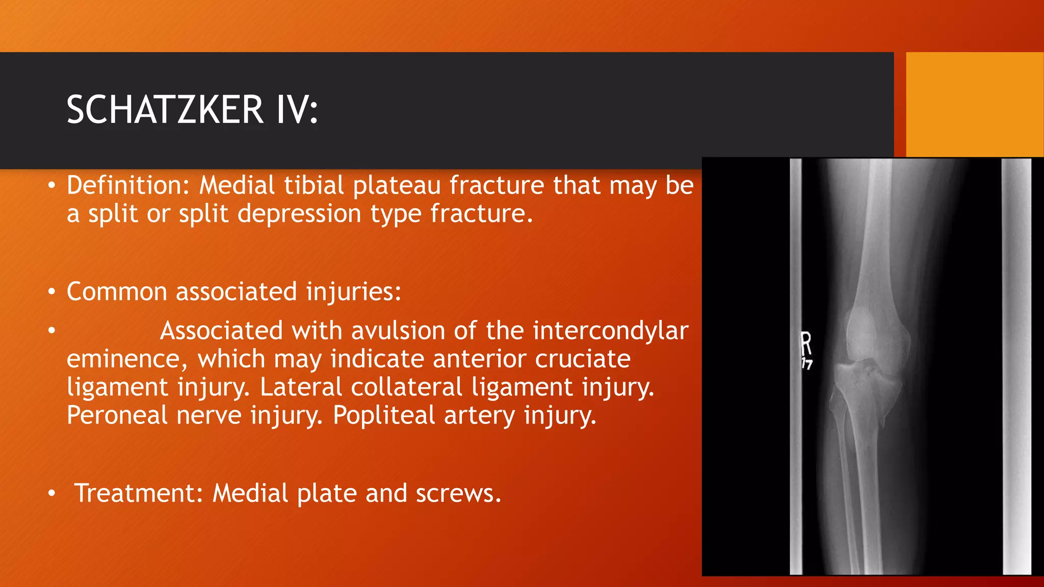 PROXIMAL TIBIAL FRACTURE.pptx