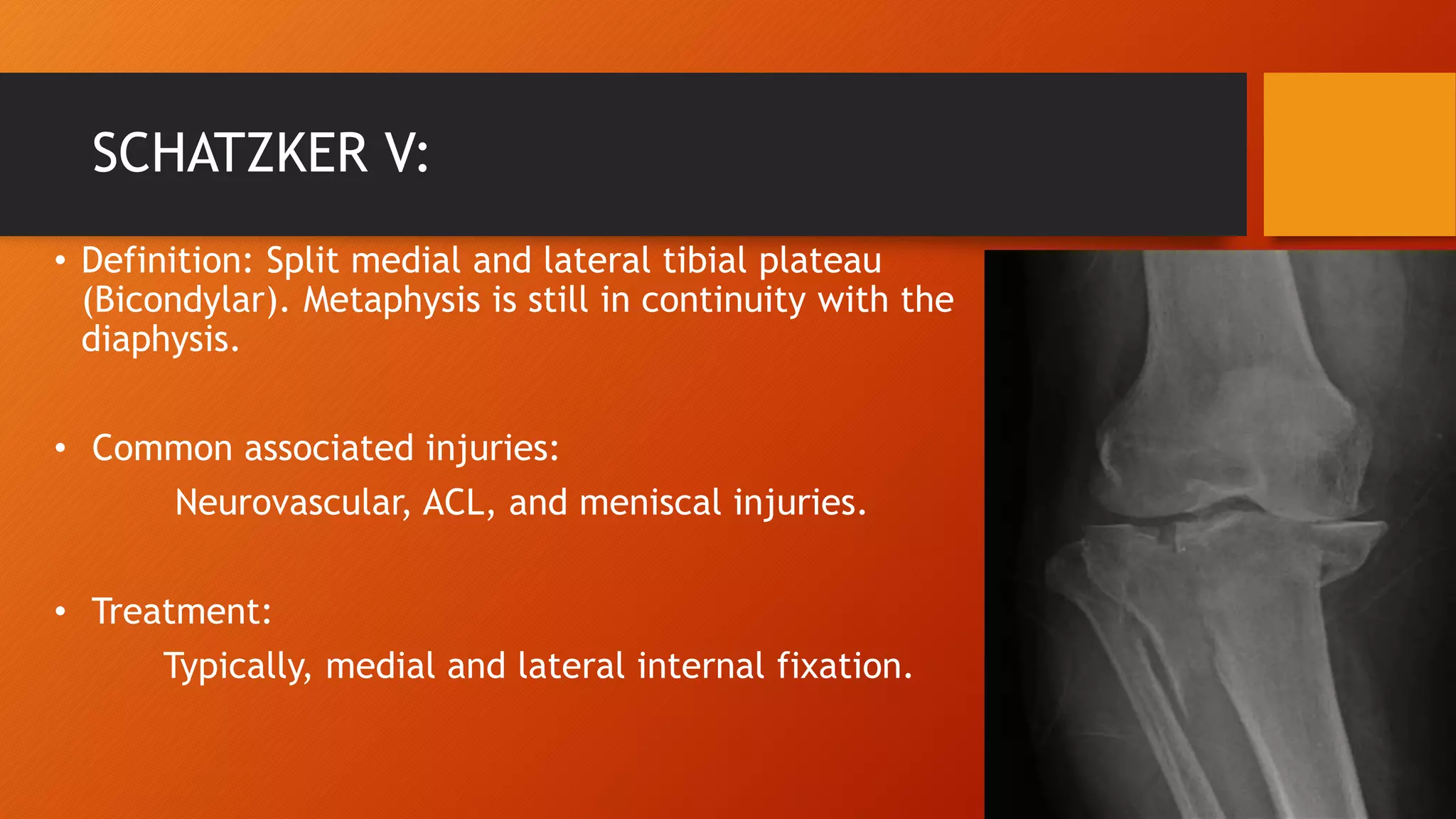 PROXIMAL TIBIAL FRACTURE.pptx