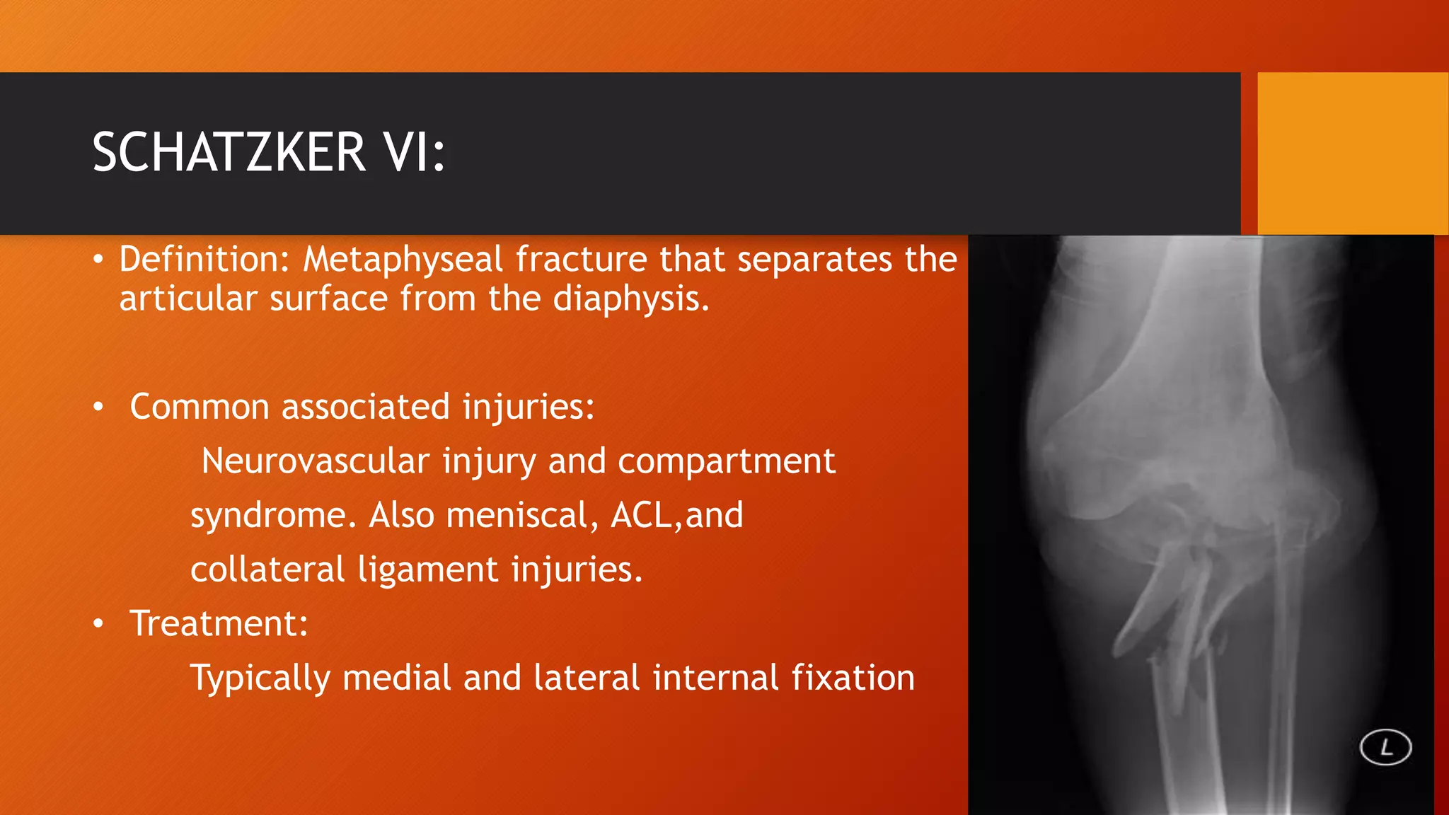 PROXIMAL TIBIAL FRACTURE.pptx