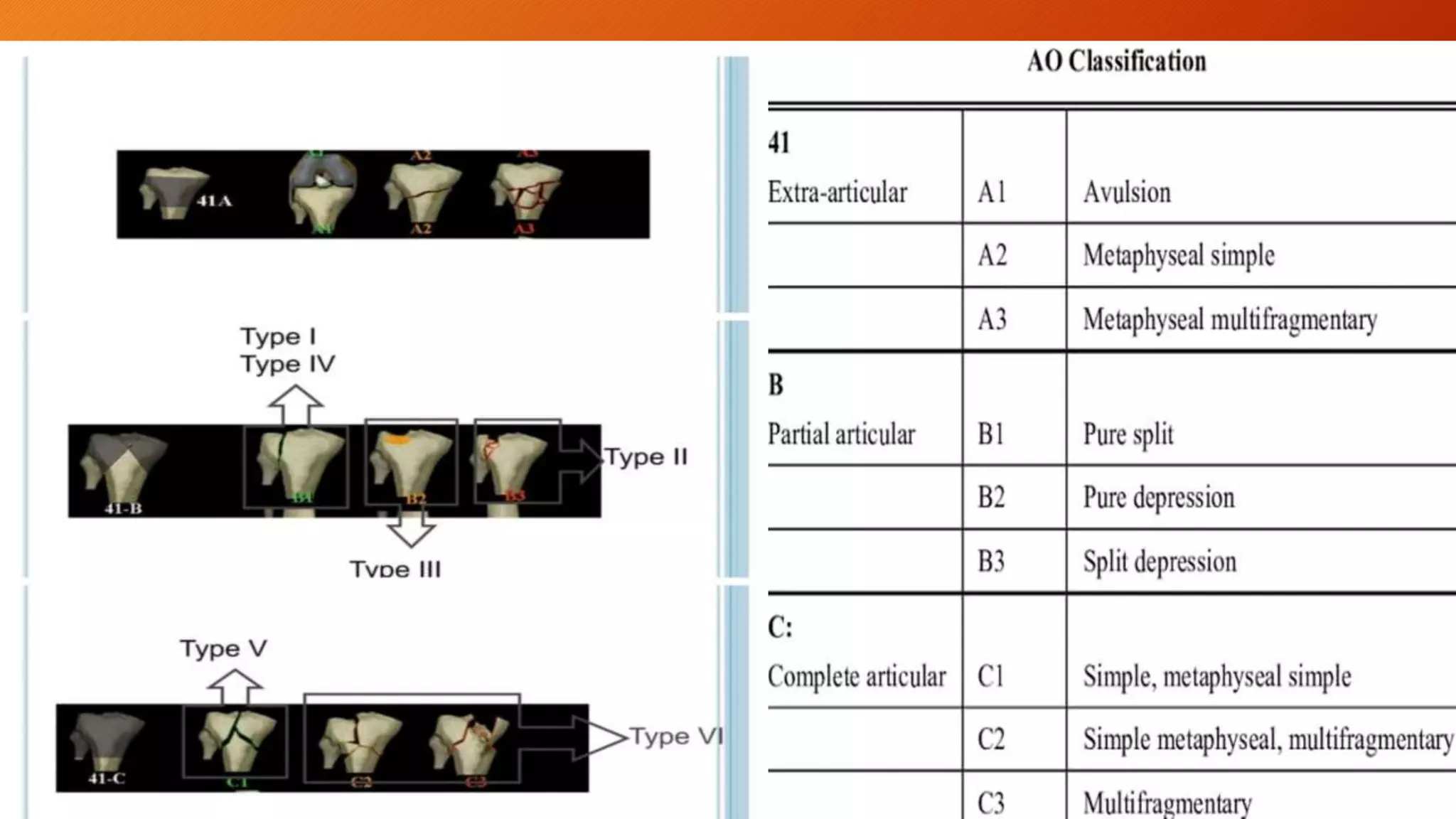 PROXIMAL TIBIAL FRACTURE.pptx