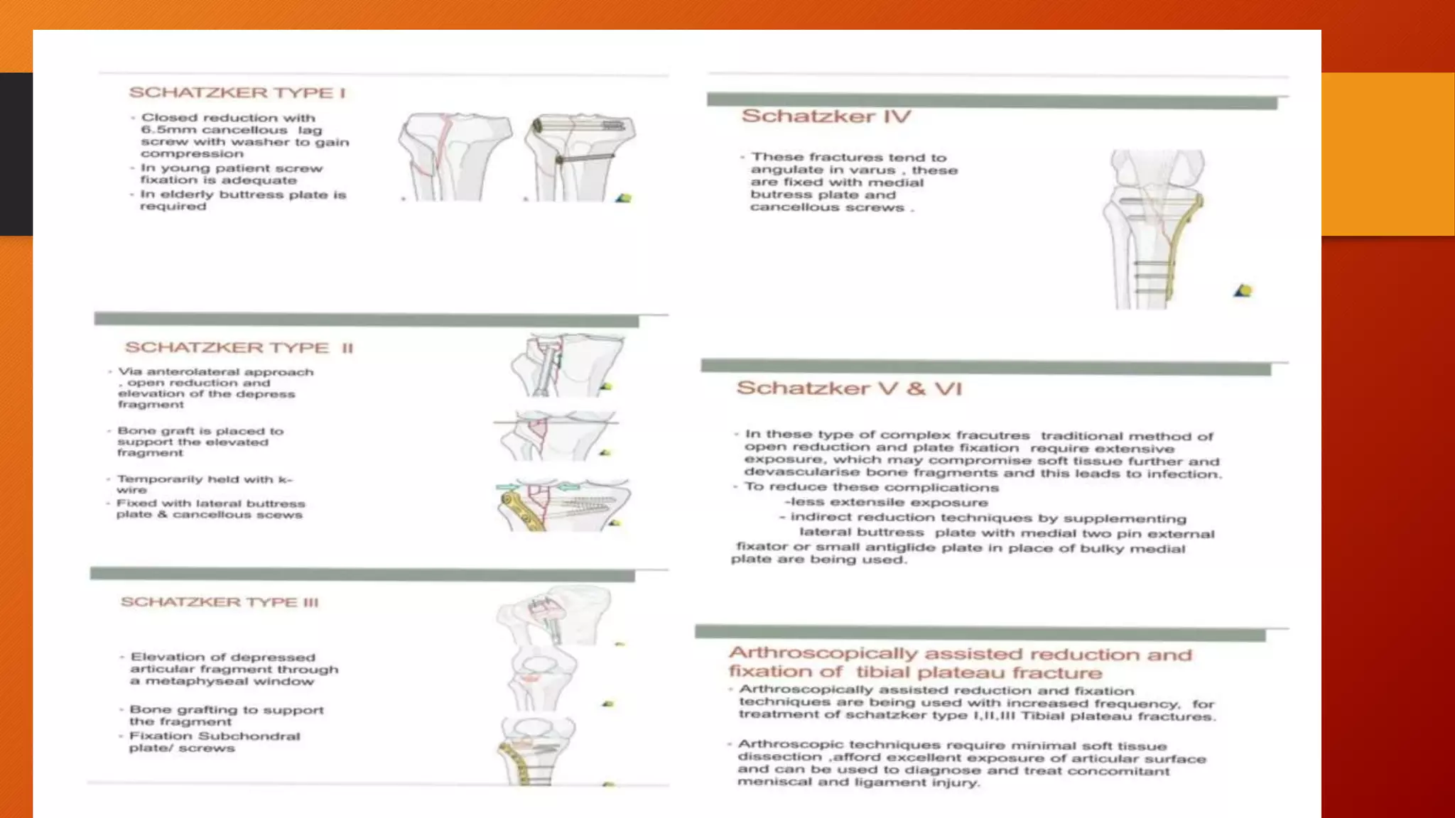 PROXIMAL TIBIAL FRACTURE.pptx