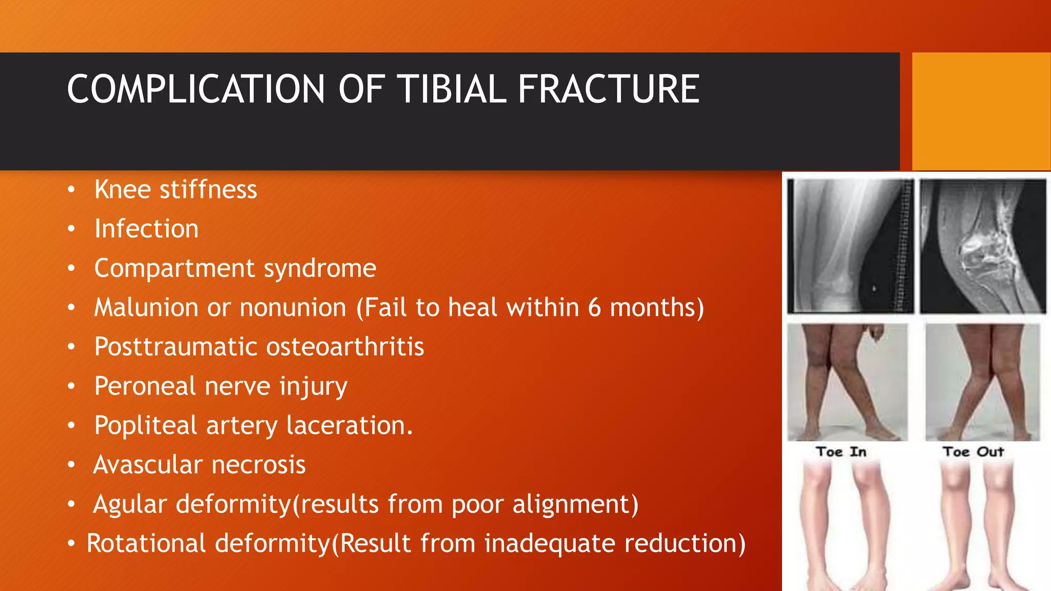 PROXIMAL TIBIAL FRACTURE.pptx
