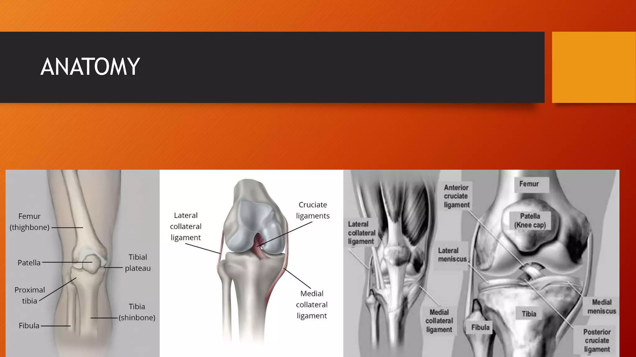 PROXIMAL TIBIAL FRACTURE.pptx