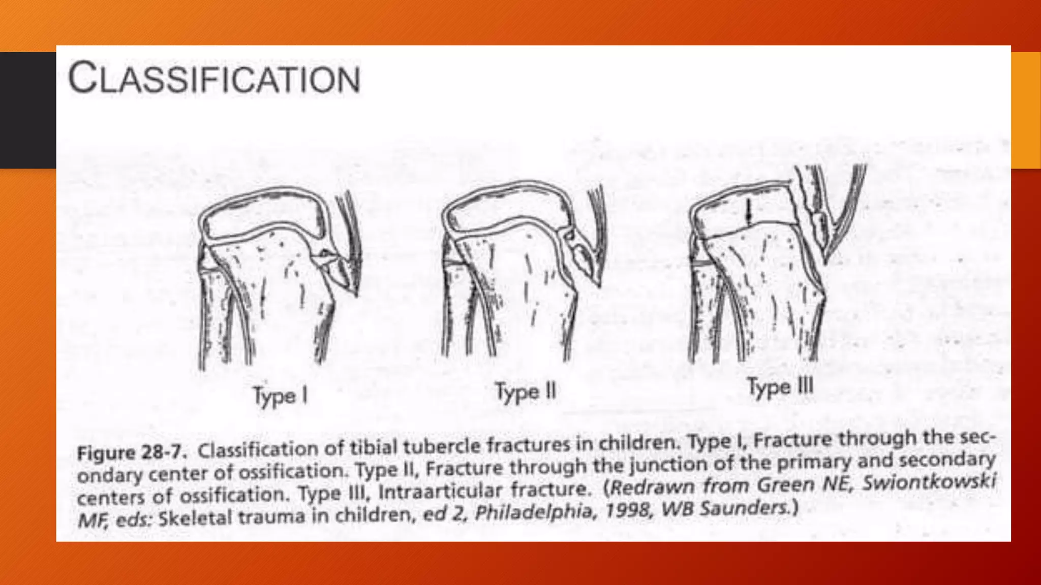 PROXIMAL TIBIAL FRACTURE.pptx