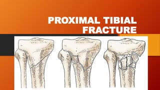PROXIMAL TIBIAL FRACTURE.pptx