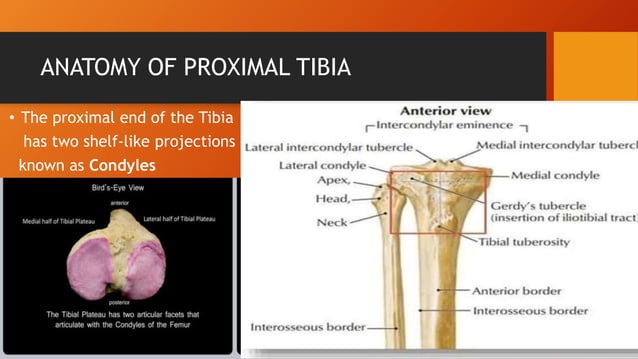 PROXIMAL TIBIAL FRACTURE.pptx | Death, Injury, or Military Conflict ...